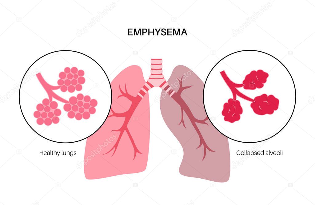 Concepto de enfermedad por enfisema. Alvéolos dañados, vías respiratorias averiadas. Paredes ...