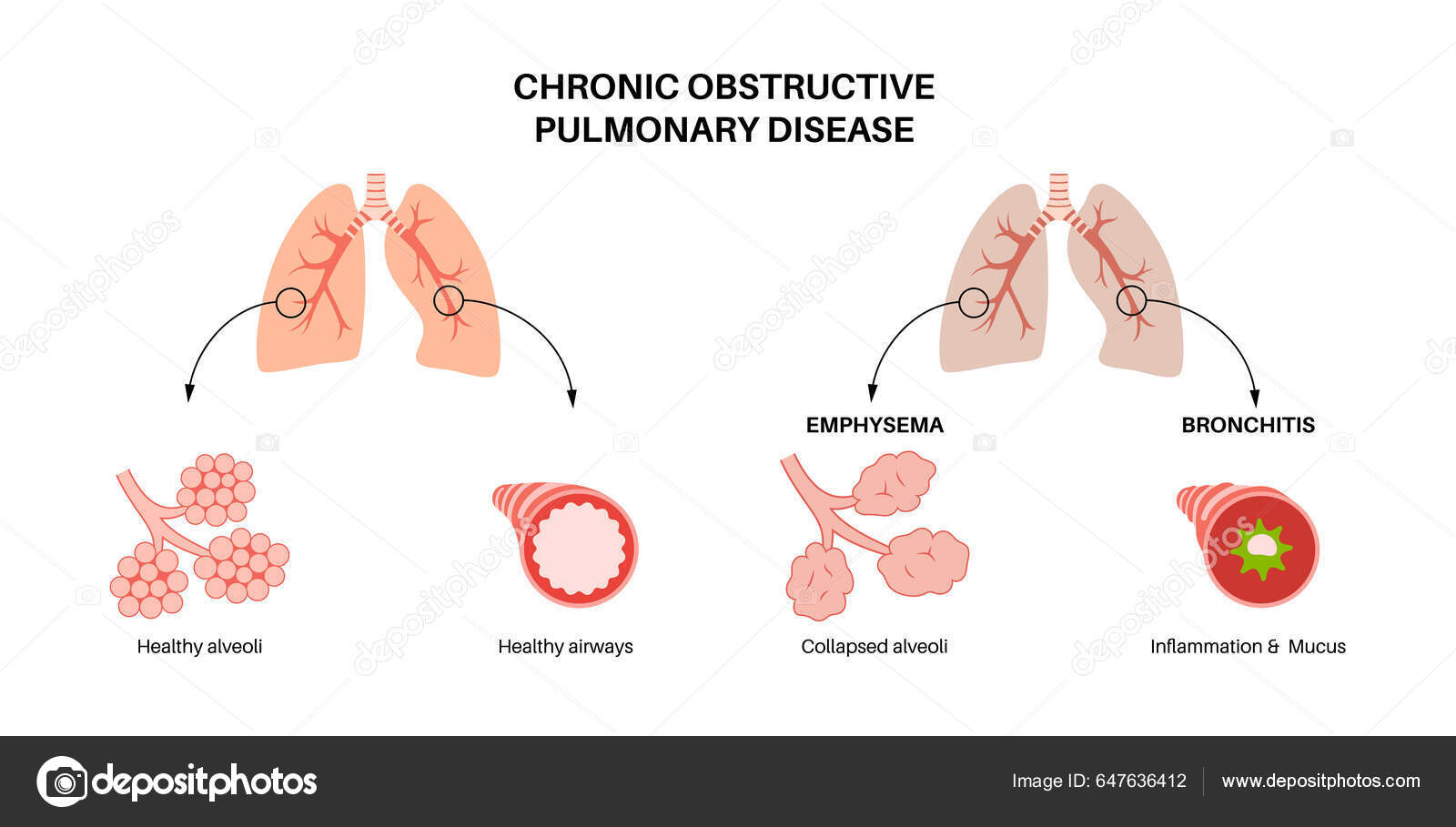 Chronická Obstrukční Plicní Nemoc Nebo Chopn Skupina Plicních ...