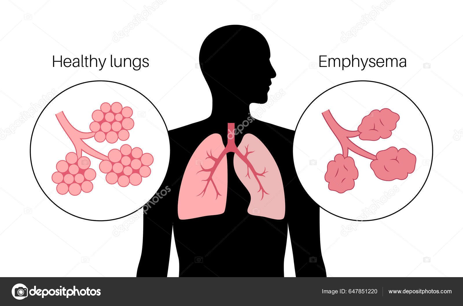 Begrebet Emfysem Sygdom Beskadigede Alveoler Fejlluftveje Floppy Vægge ...