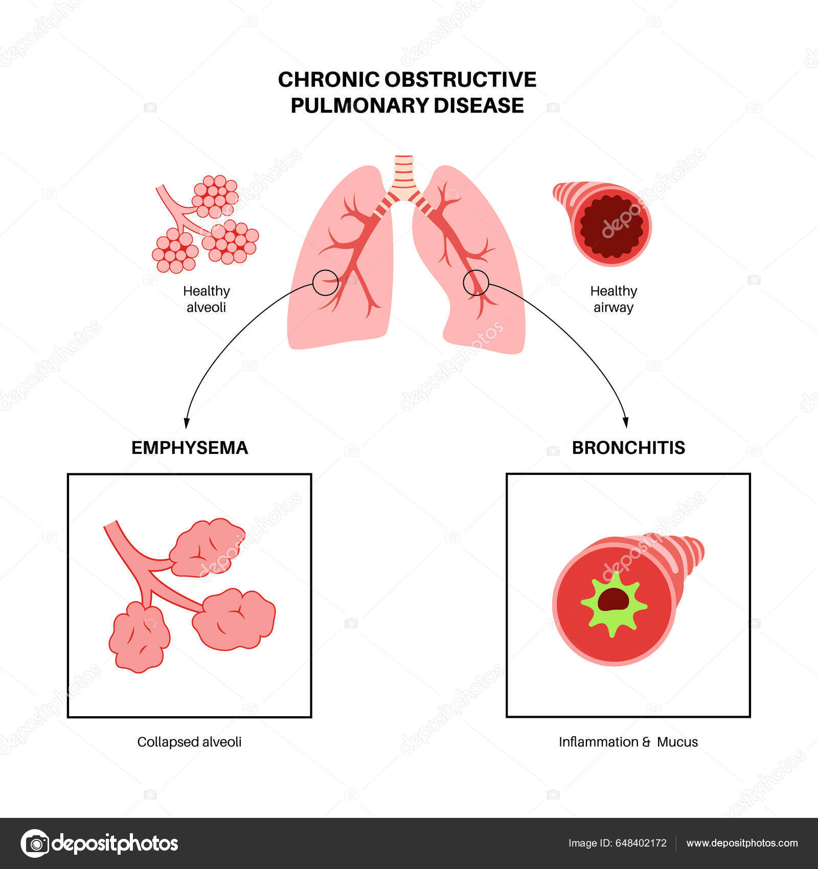 Enfermedad Pulmonar Obstructiva Crónica Epoc Grupo Enfermedades ...