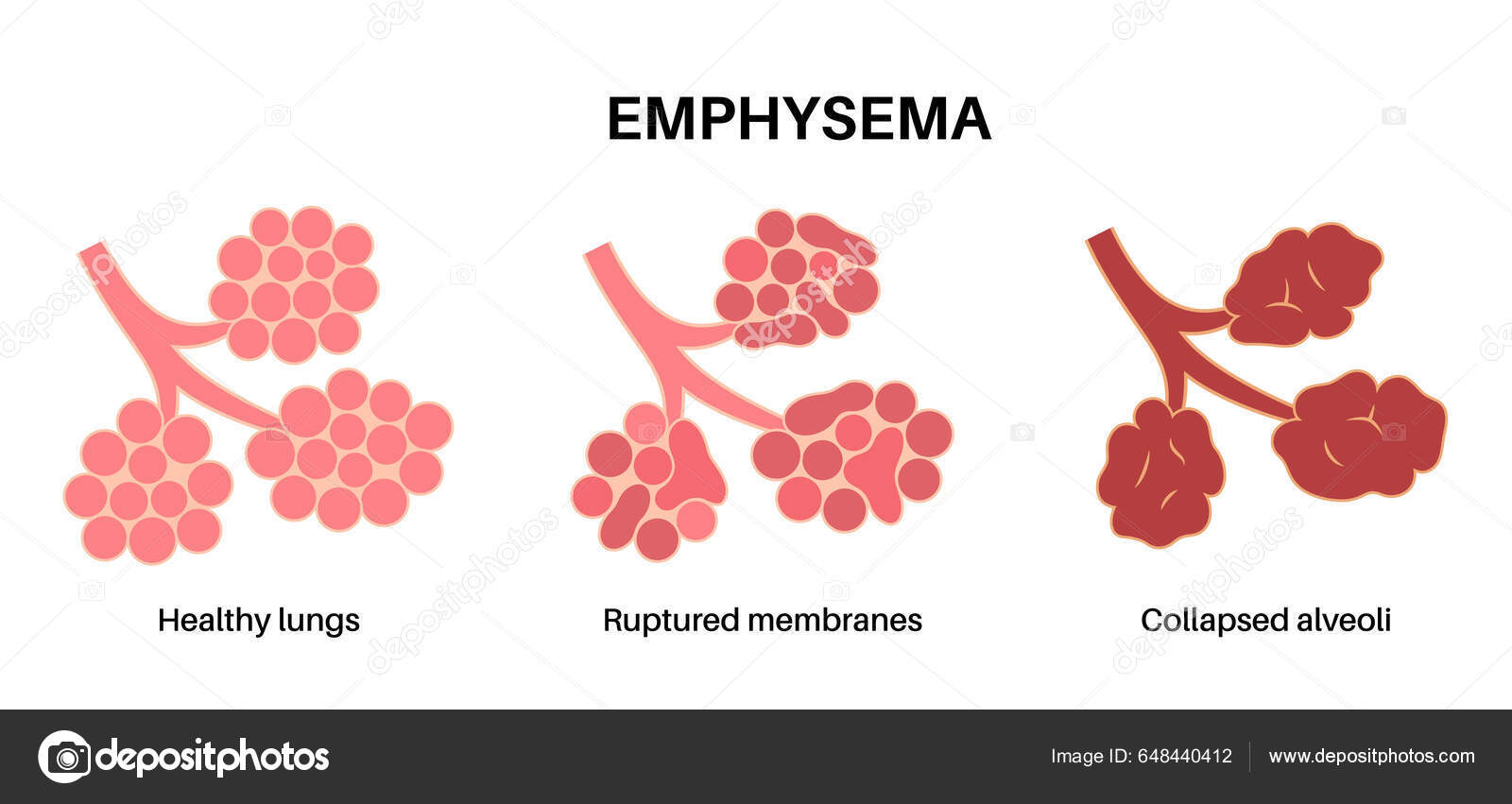Concepto Enfermedad Por Enfisema Alvéolos Dañados Vías Respiratorias ...