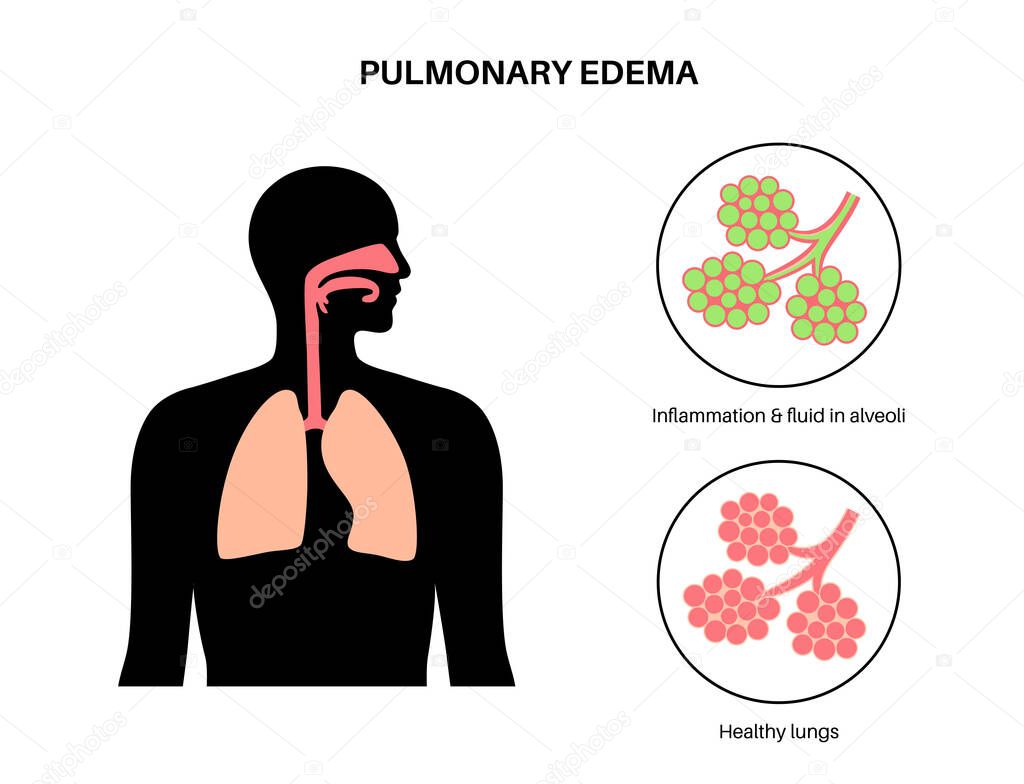 Edema Pulmonar Cardiopapers