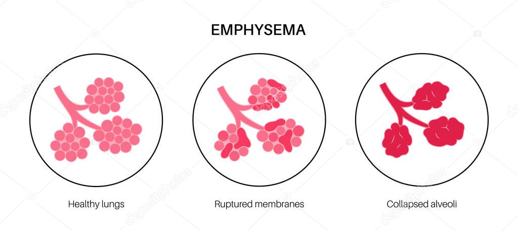 Concepto de enfermedad por enfisema. Alvéolos dañados, vías respiratorias averiadas. Paredes ...