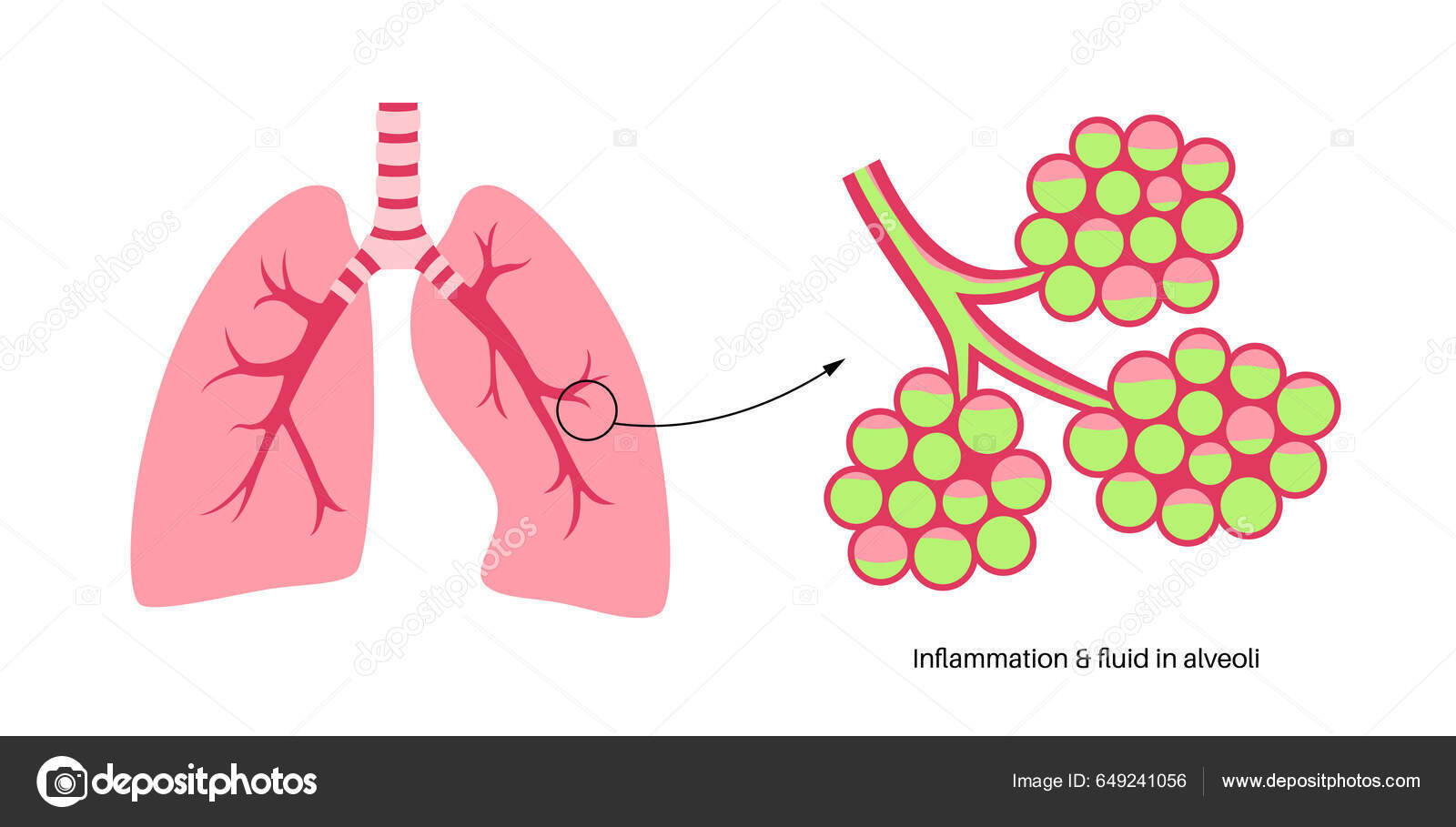 Keuhkokuume Infektio Anatominen Juliste Tulehdus Ihmisen ...