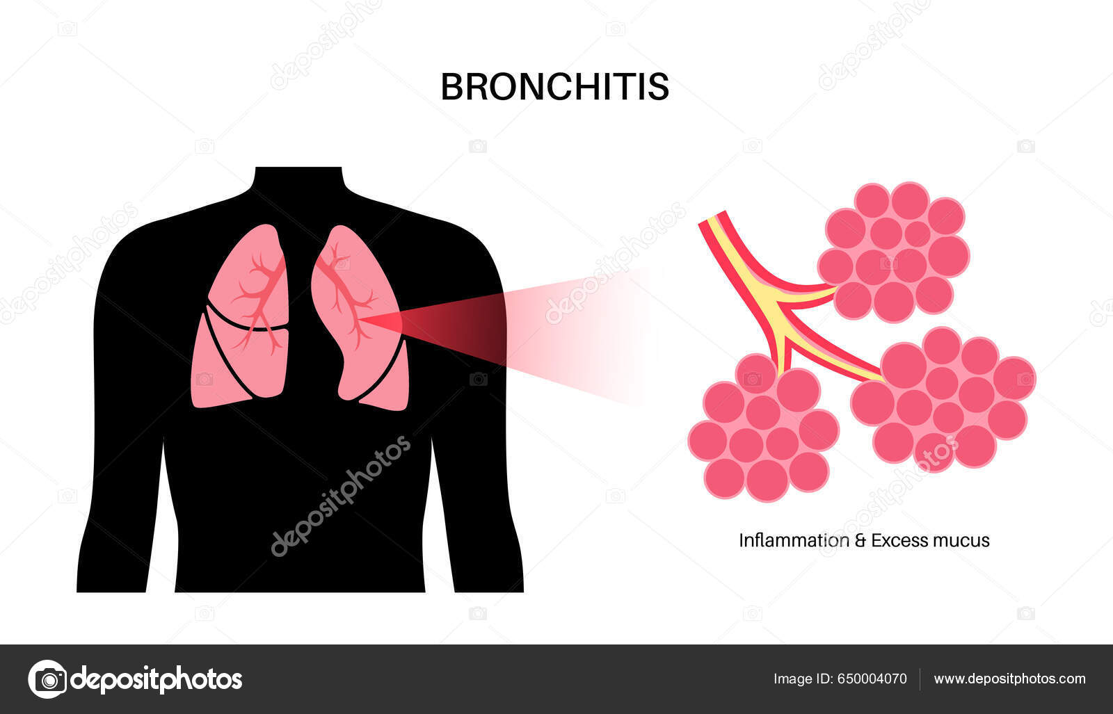 Bronkit Koncept Infektion Lungorna Bronchis Anatomiska Affisch ...