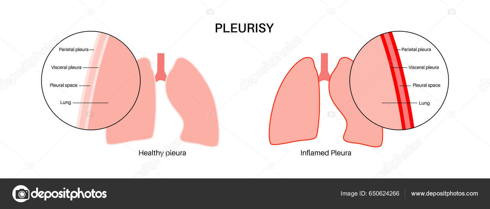 Concepto Enfermedad Pleuresía Inflamación Los Pulmones Dolor Torácico ...