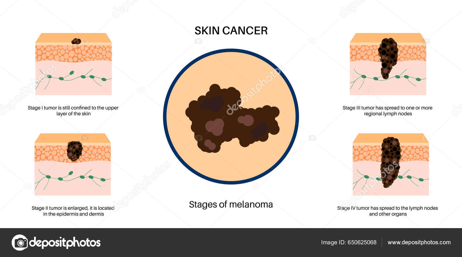 Estadios Del Desarrollo Progresión Del Cáncer Piel Melanoma Crecimiento ...