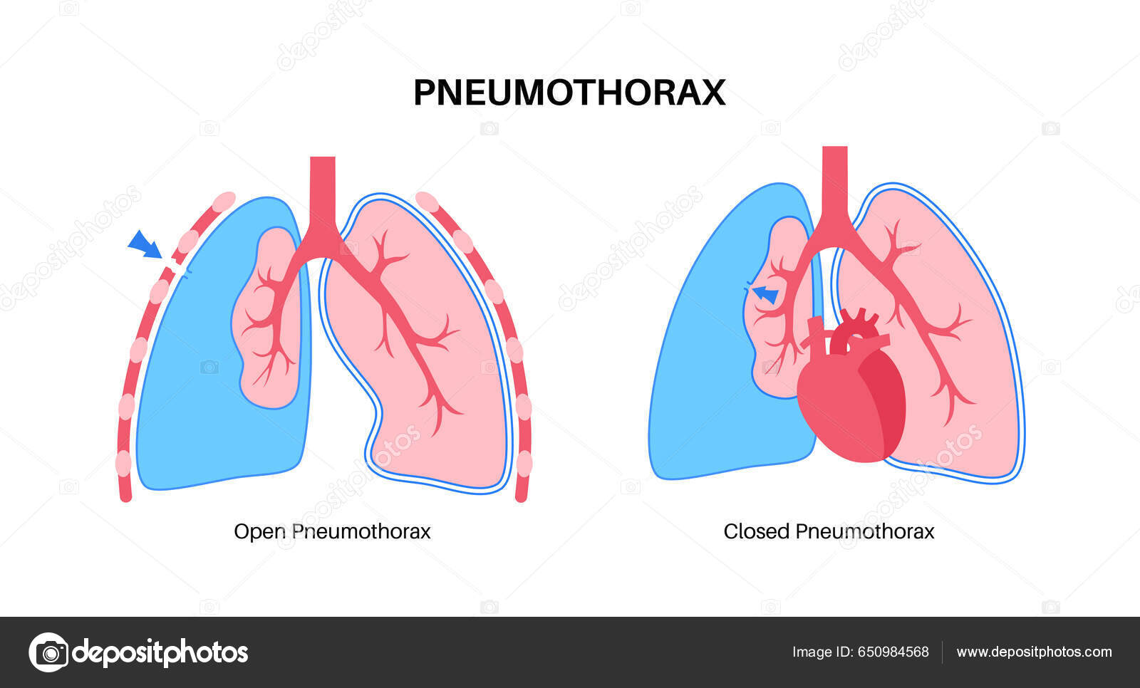 Doença Pneumotórax Vetor Plano Cartaz Médico Pulmão Colapso Espaço ...