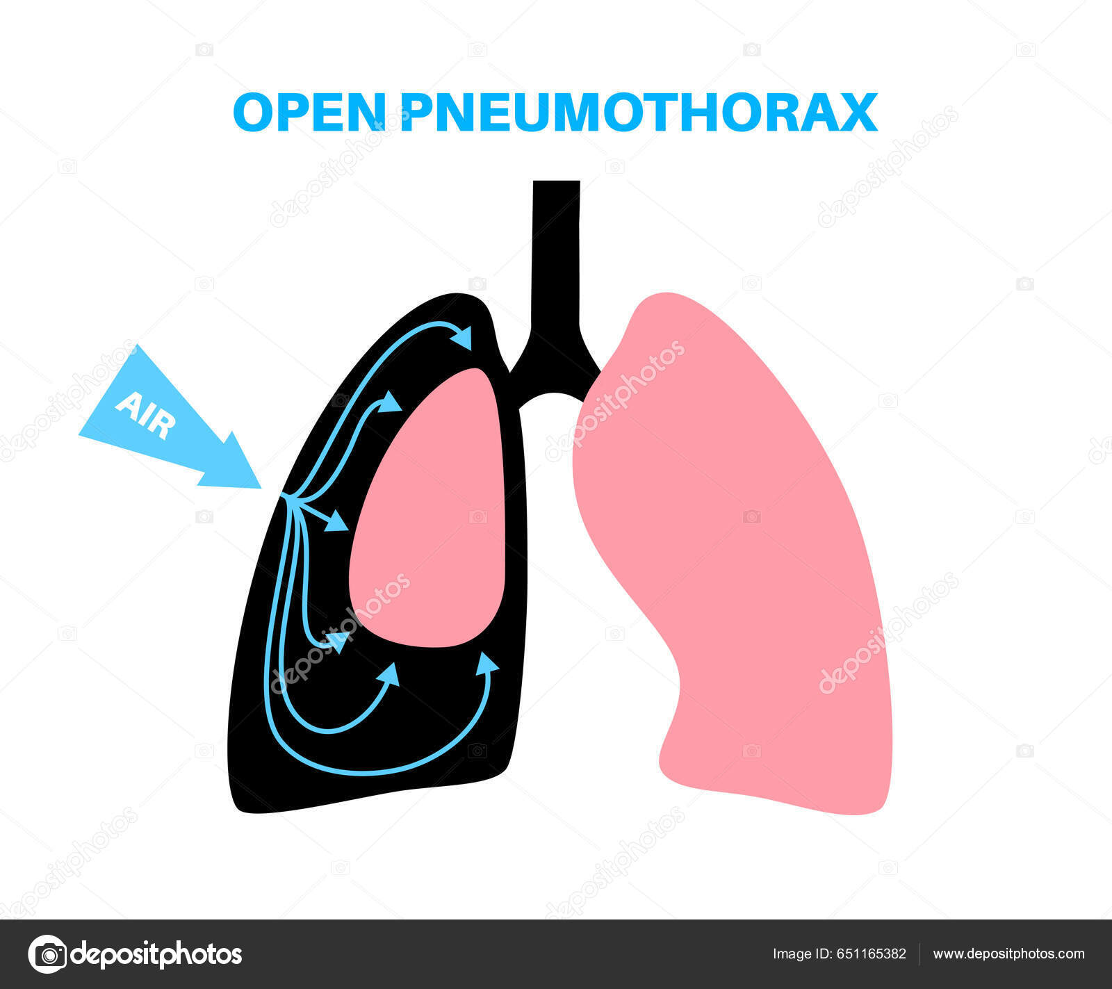Enfermedad Del Neumotórax Vector Plano Cartel Médico Pulmonar Colapsado ...