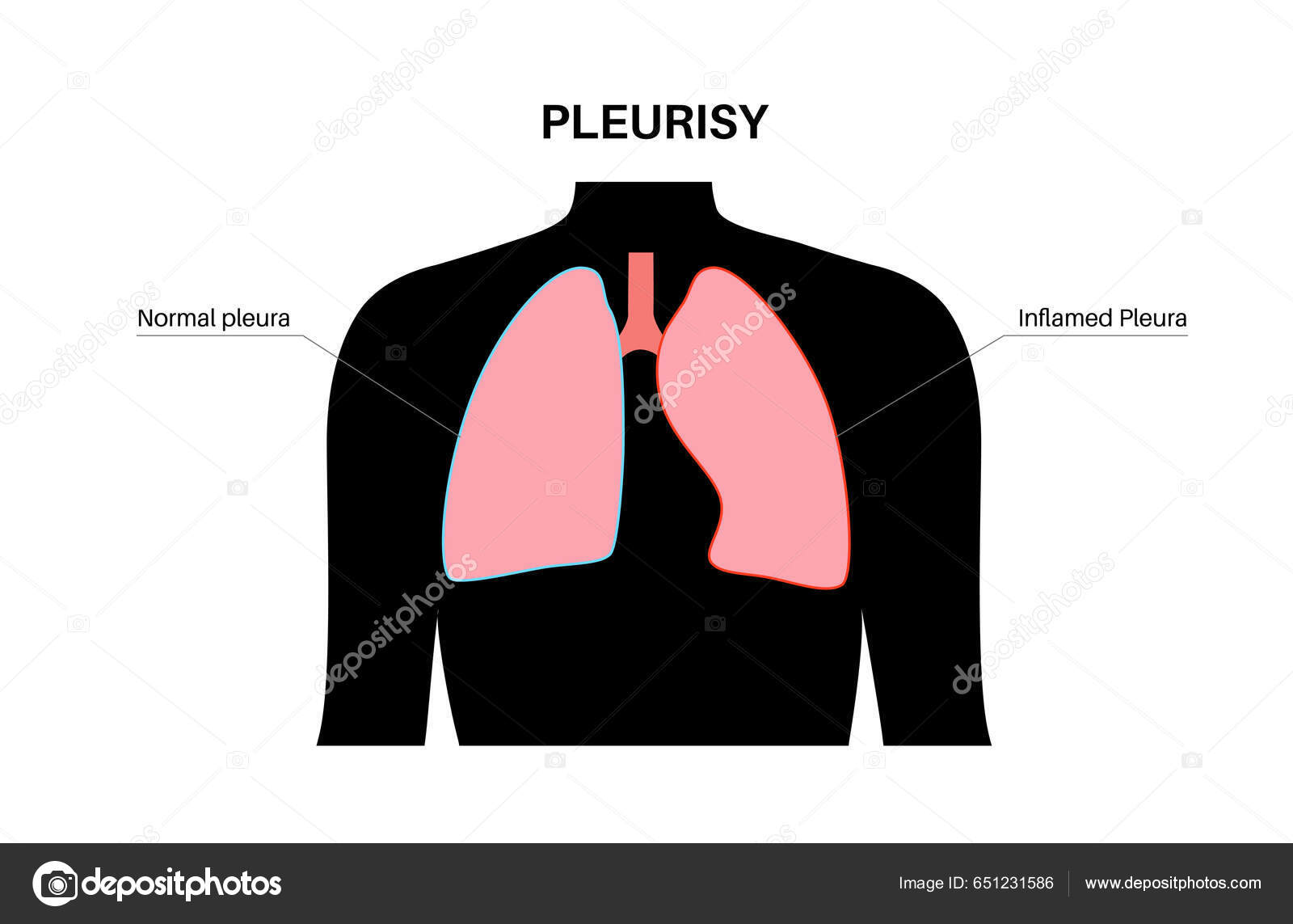 Concepto Enfermedad Pleuresía Inflamación Los Pulmones Dolor Torácico ...