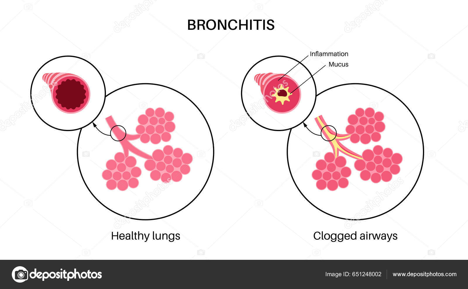 Keuhkoputkentulehdus Käsite Infektio Keuhkoissa Bronchin Anatominen ...