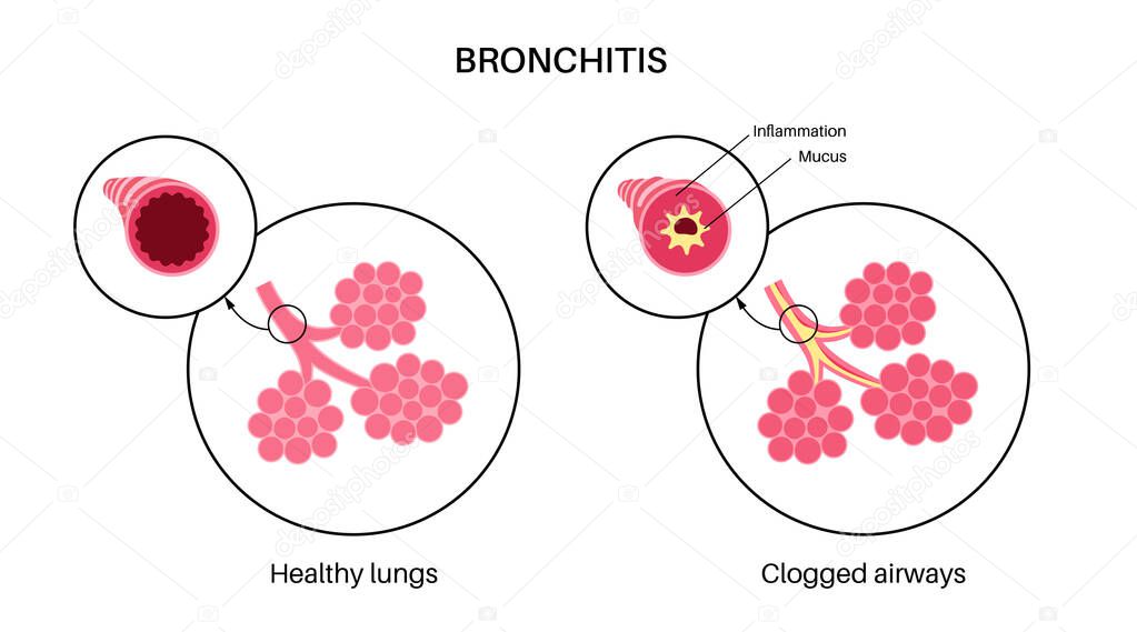 Concepto de bronquitis, infección de los pulmones. Cartel anatómico de ...
