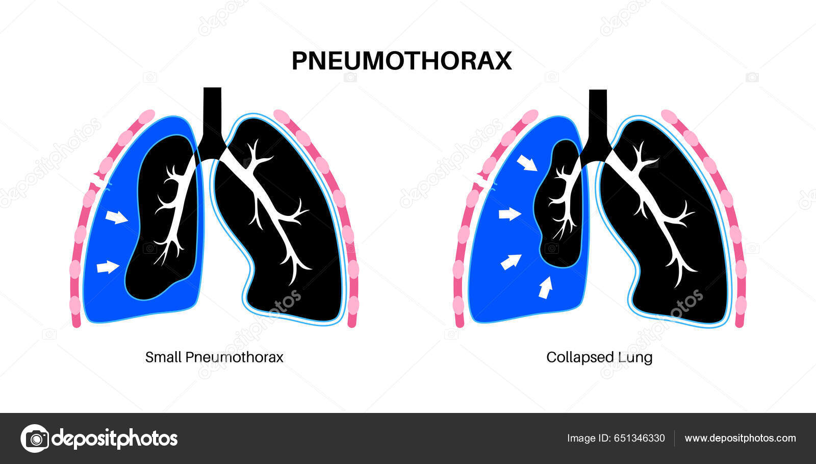 Enfermedad Del Neumotórax Vector Plano Cartel Médico Pulmonar Colapsado ...