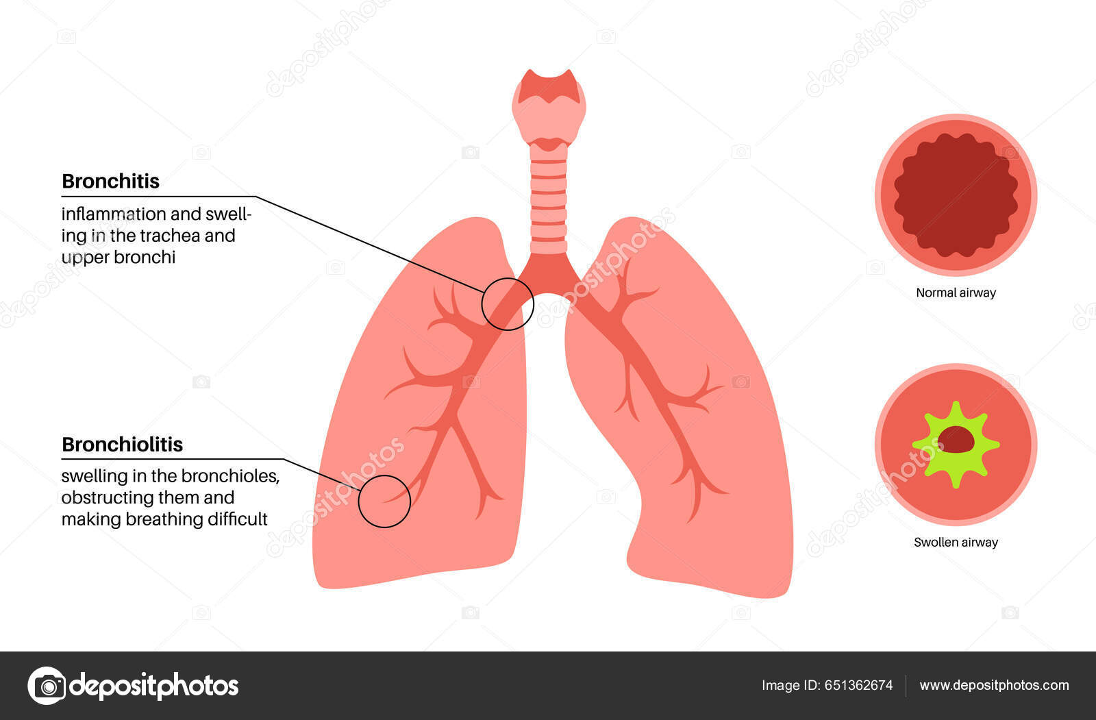 Bronchitis Und Bronchiolitis Infektion Der Lungen Bronchi Anatomisches ...
