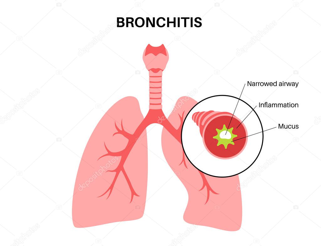 Concepto de bronquitis, infección de los pulmones. Cartel anatómico de ...