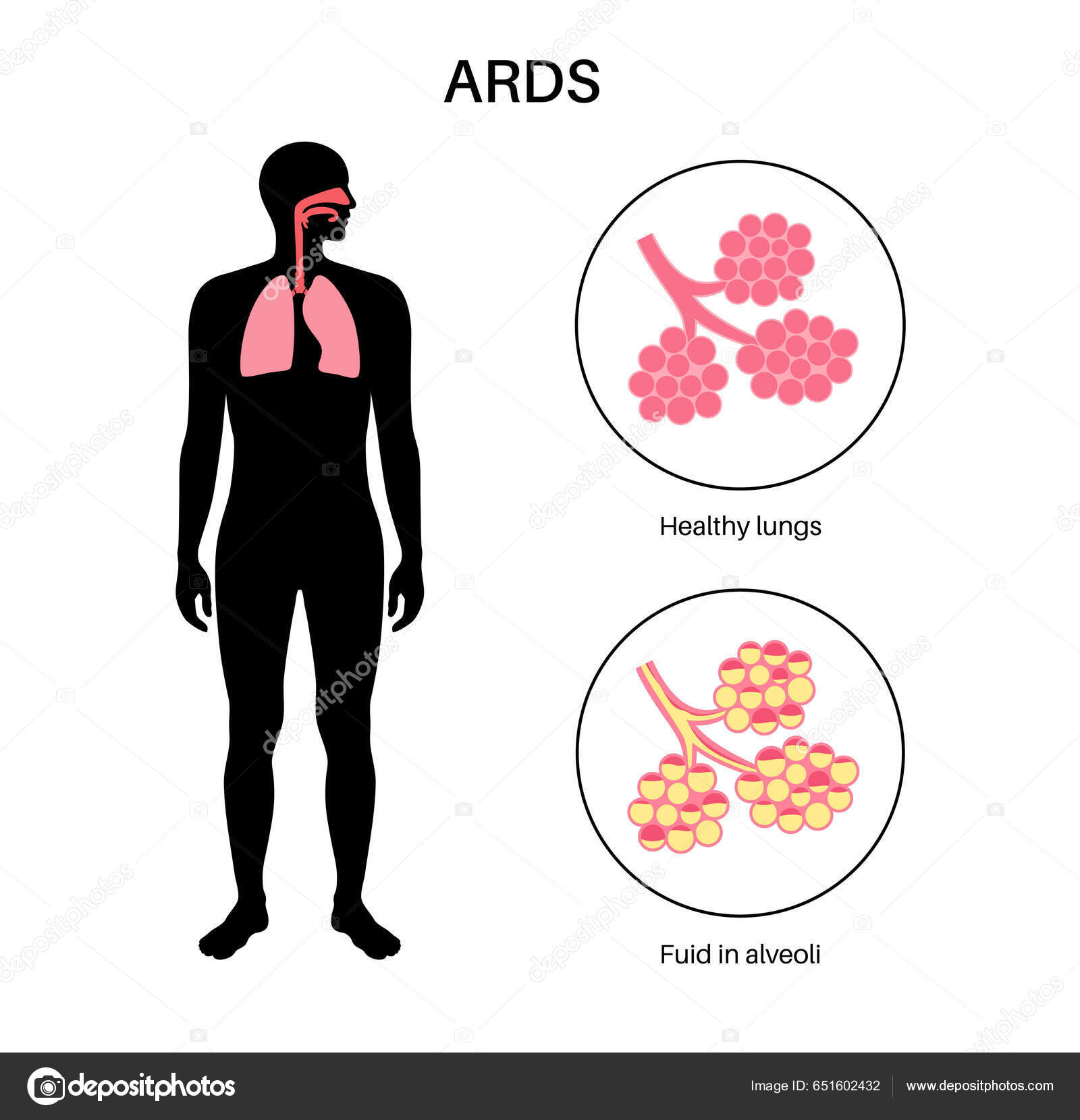 Acute Respiratory Distress Syndrome Lungs Cannot Enough Oxygen Ards ...