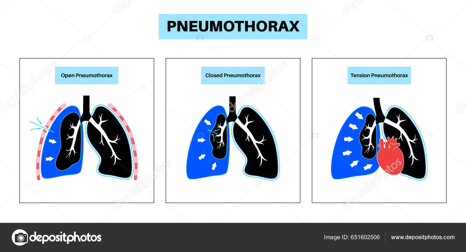Enfermedad Del Neumotórax Vector Plano Cartel Médico Pulmonar Colapsado ...