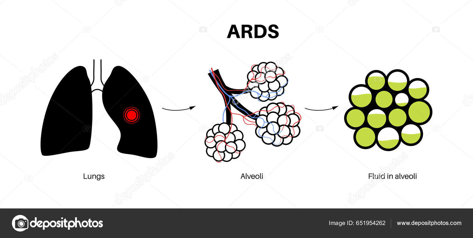 Acute Respiratory Distress Syndrome Lungs Cannot Enough Oxygen Ards ...