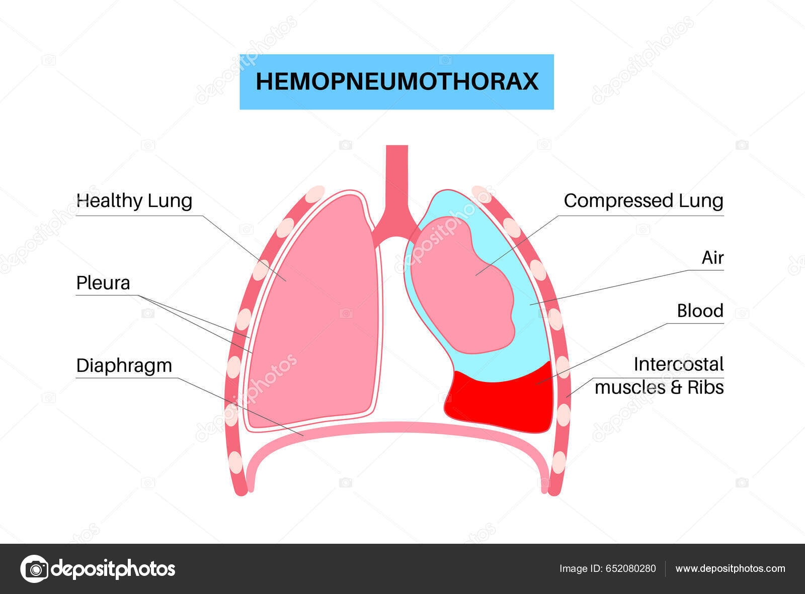 Hemopneumotórax Enfermedad Pulmonar Combinación Dos Condiciones Médicas ...