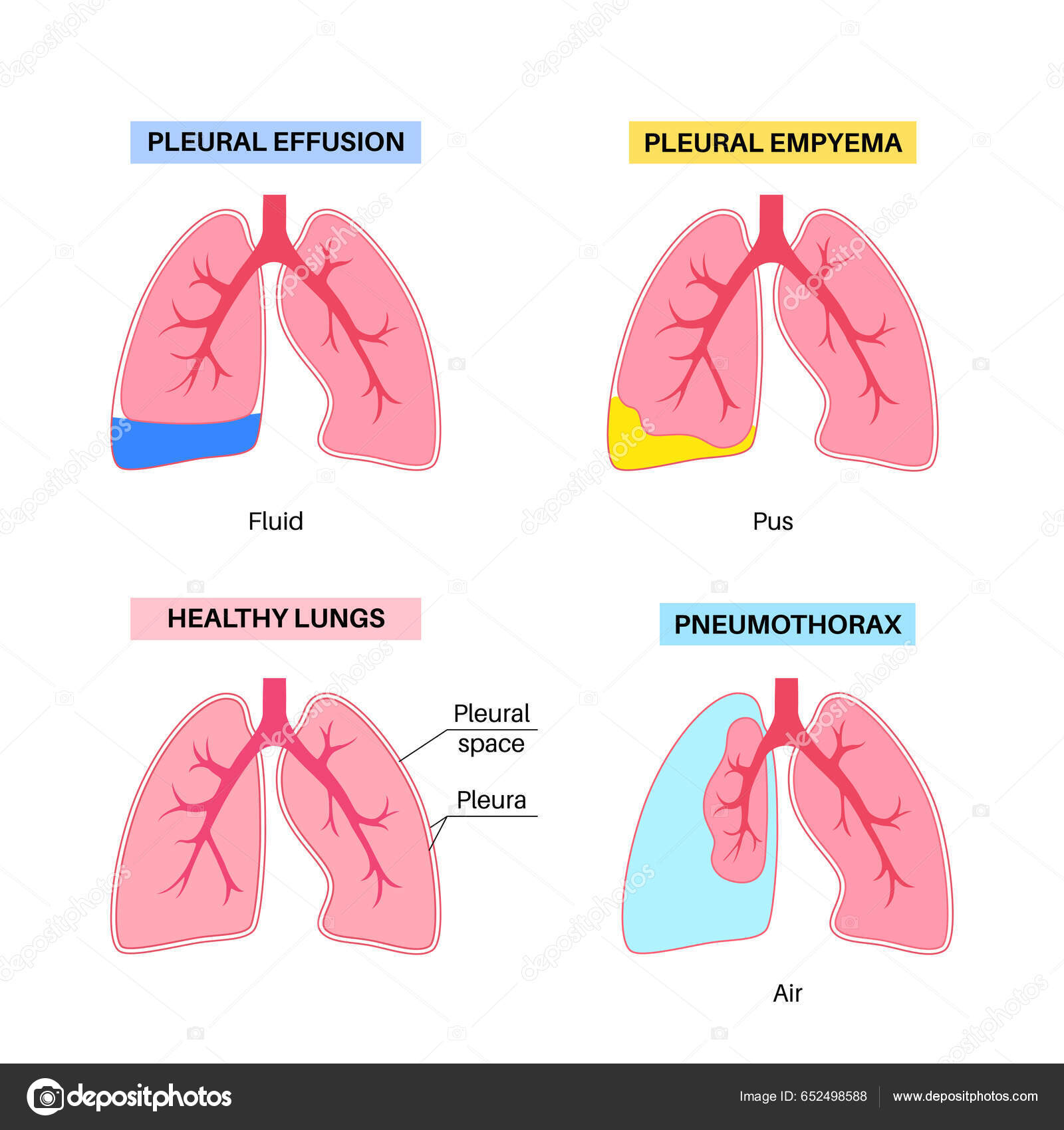 Piotórax Empiema Pleural Enfermedad Inflamatoria Pulmonar, 40% OFF