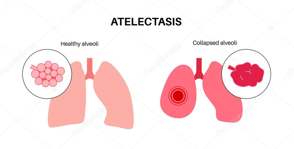 Cartel anatómico de la enfermedad de Atelectasis. Colapso total o ...