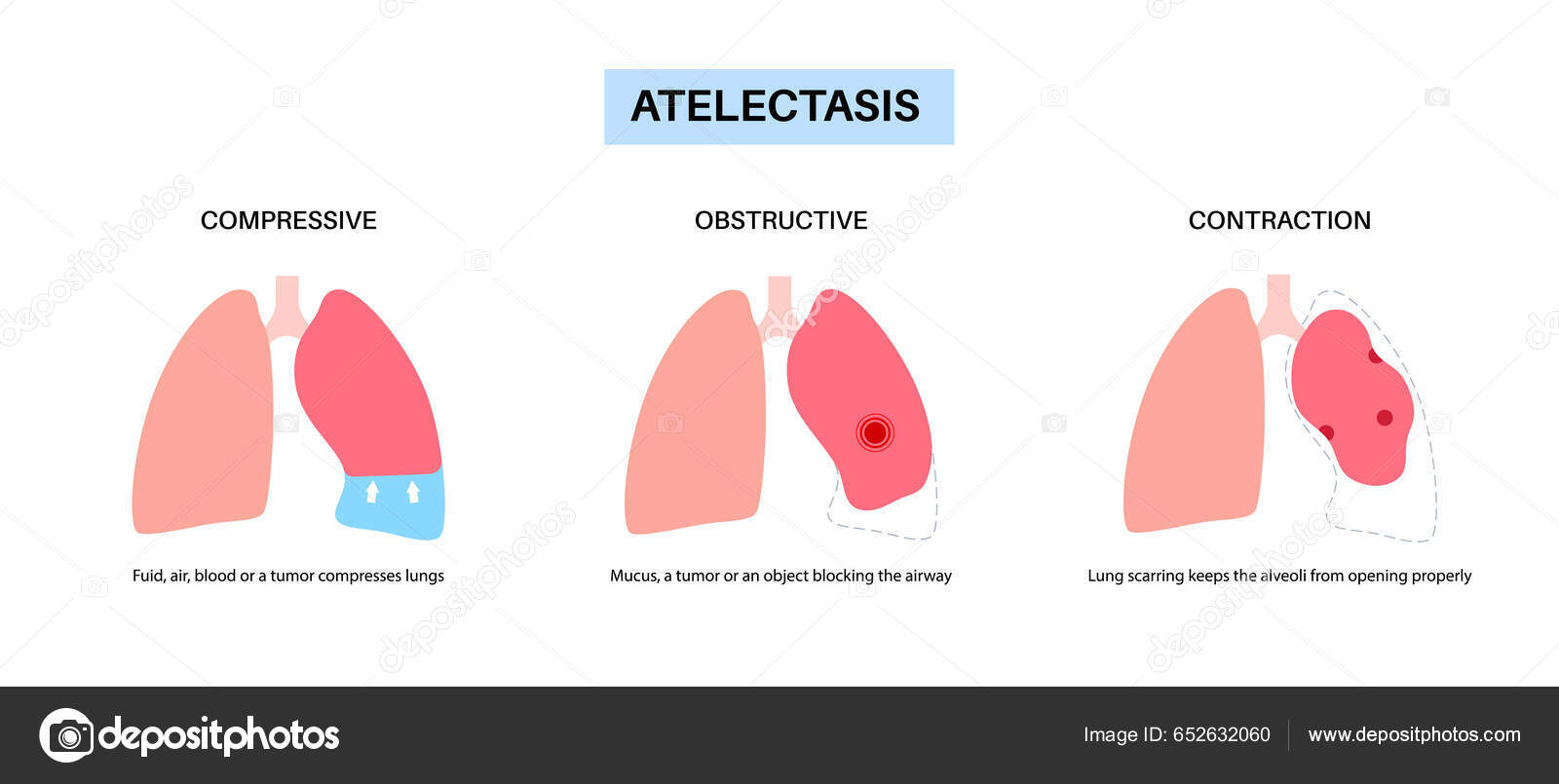 Cartel Anatómico Enfermedad Atelectasis Colapso Total Parcial Cierre ...