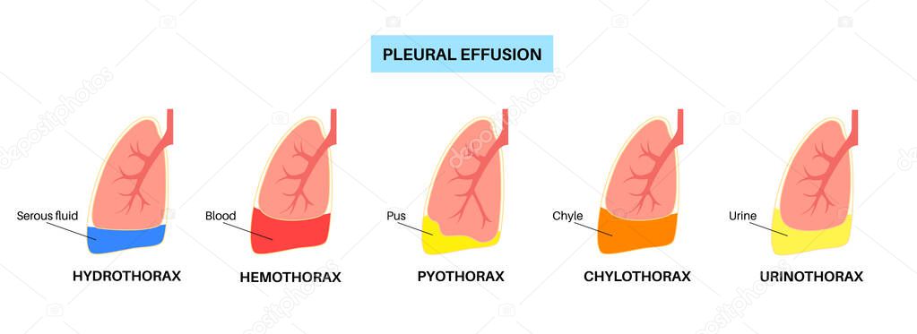 Cartel Efusión Pleural Líquido Entre Las Capas Tejido Los Pulmones ...