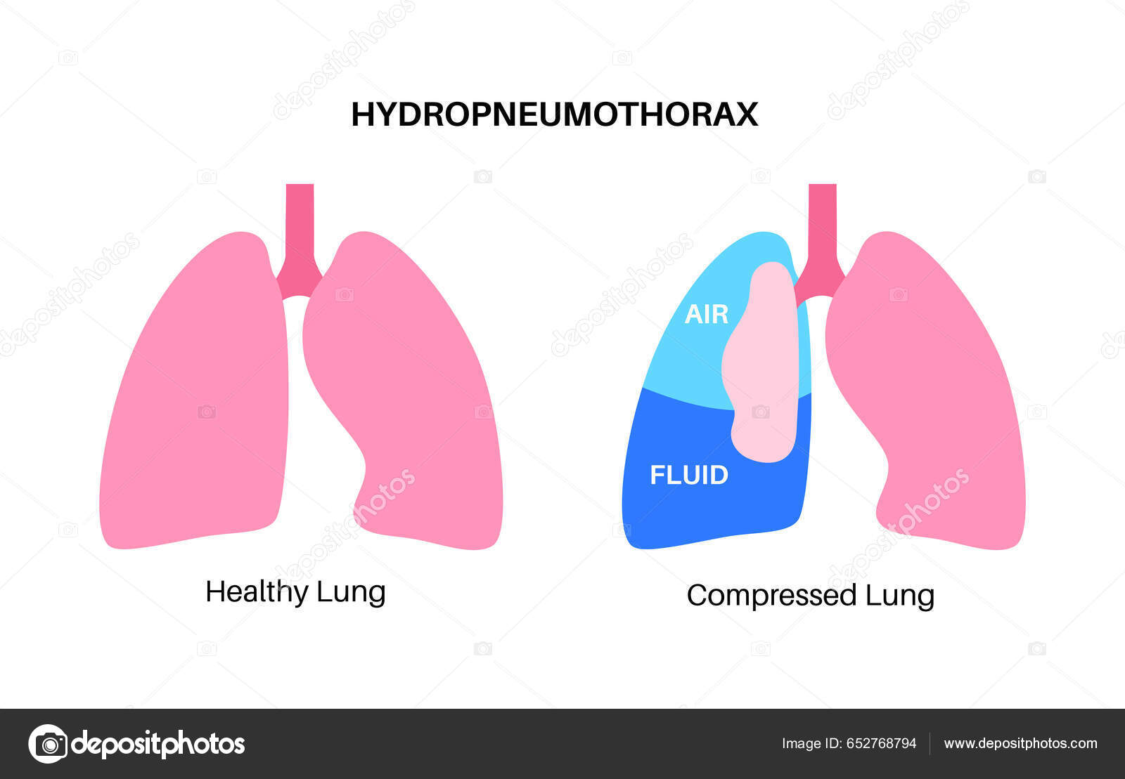 Hemopneumotórax Enfermedad Pulmonar Combinación Dos Condiciones Médicas ...