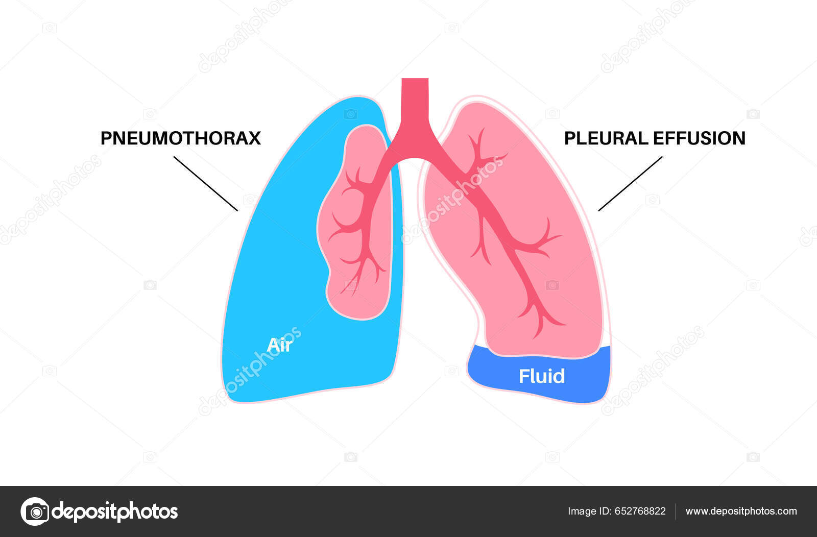 Derrame Pleural Vs Pneumotorax Recurrent Malignant Pleural Effusions