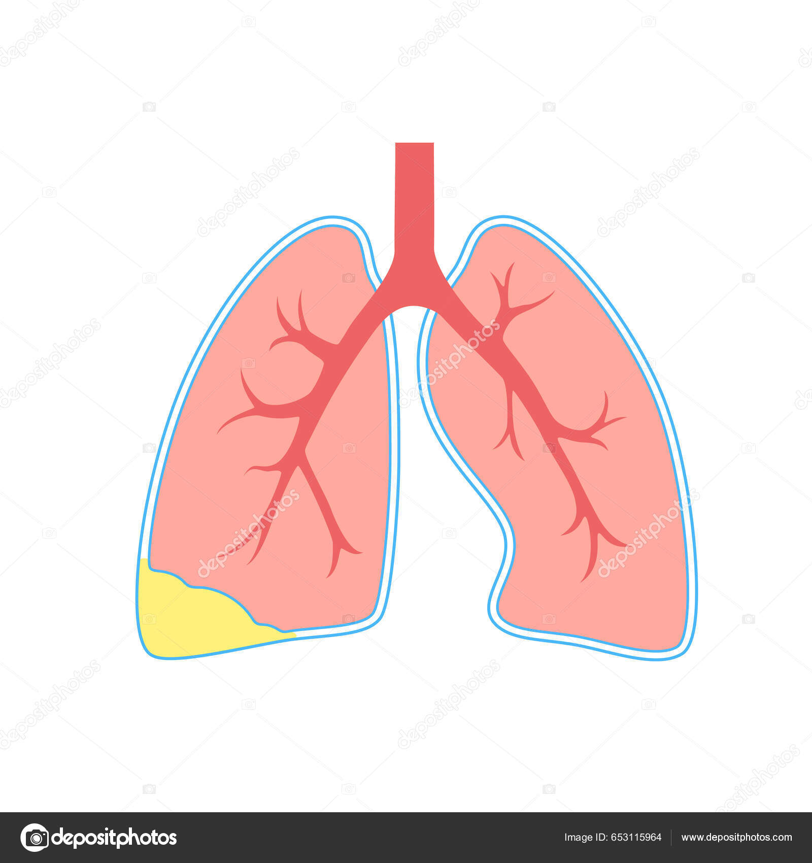 Pyothorax Pleural Empyema Lungs Inflammatory Disease Infection Chest ...