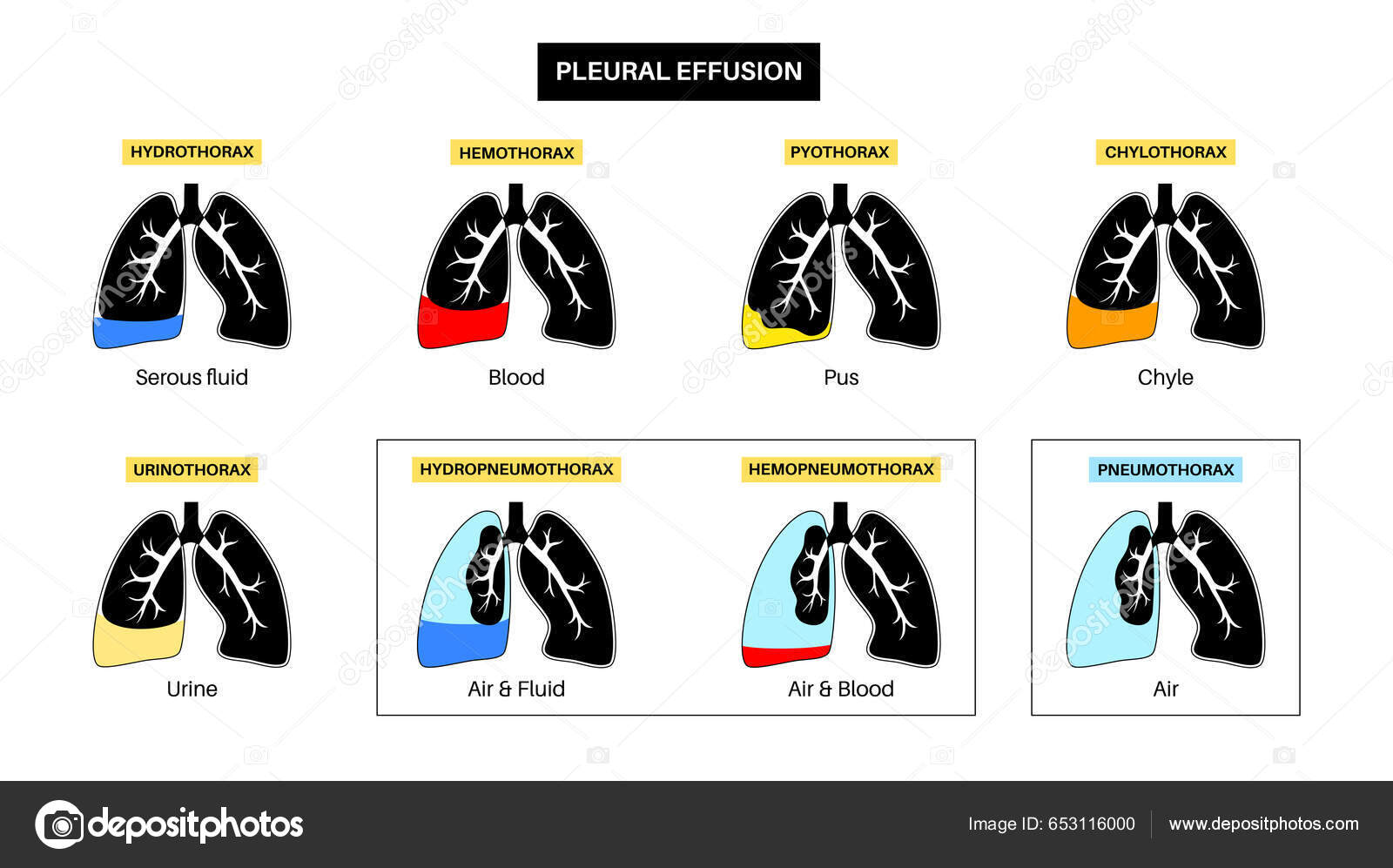 Image vectorielle Affiche D'épanchement Pleural Fluide Entre Les ...