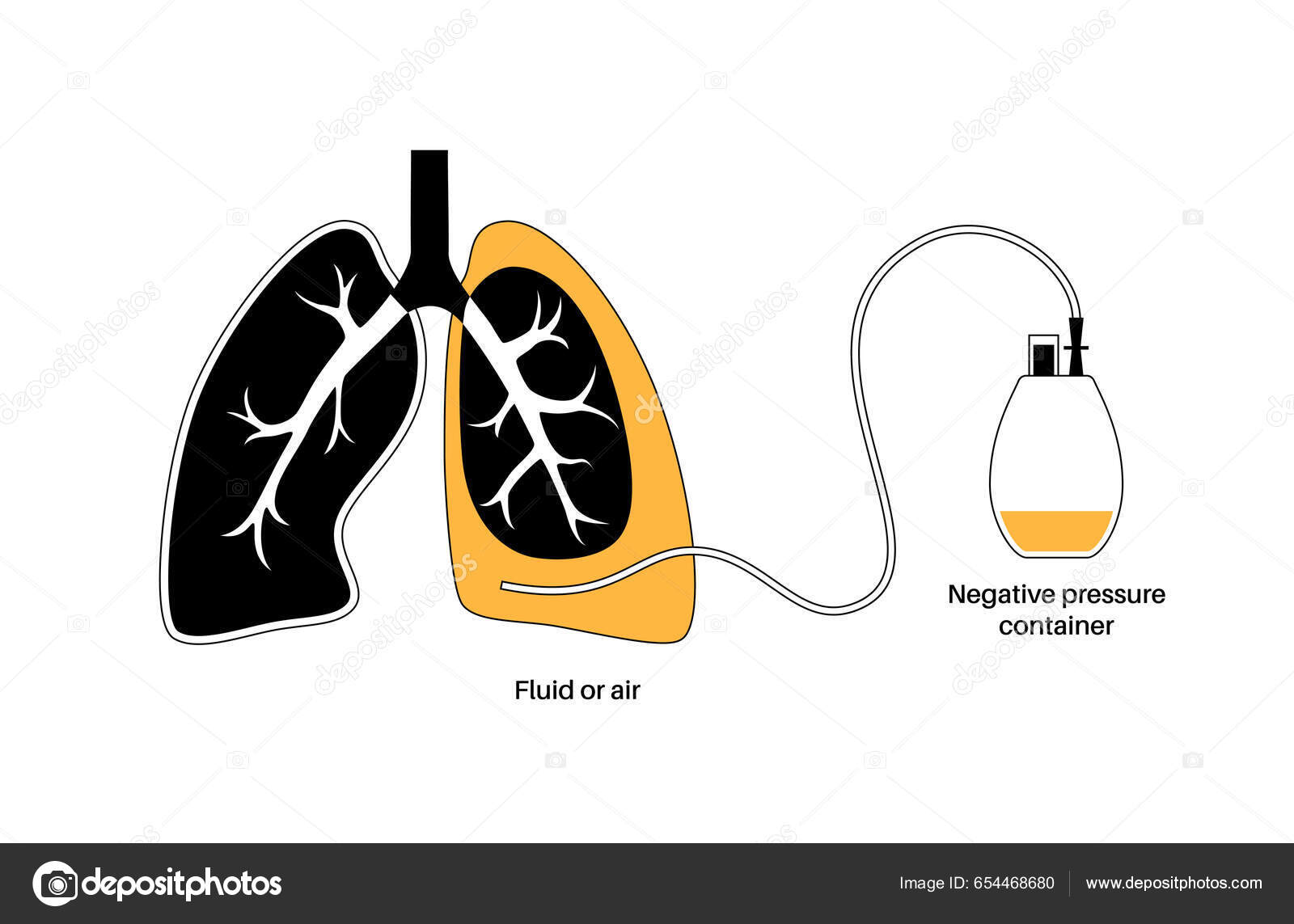Sistema Catéter Pleural Tunelizado Concepto Drenaje Pleural Ambulatorio ...
