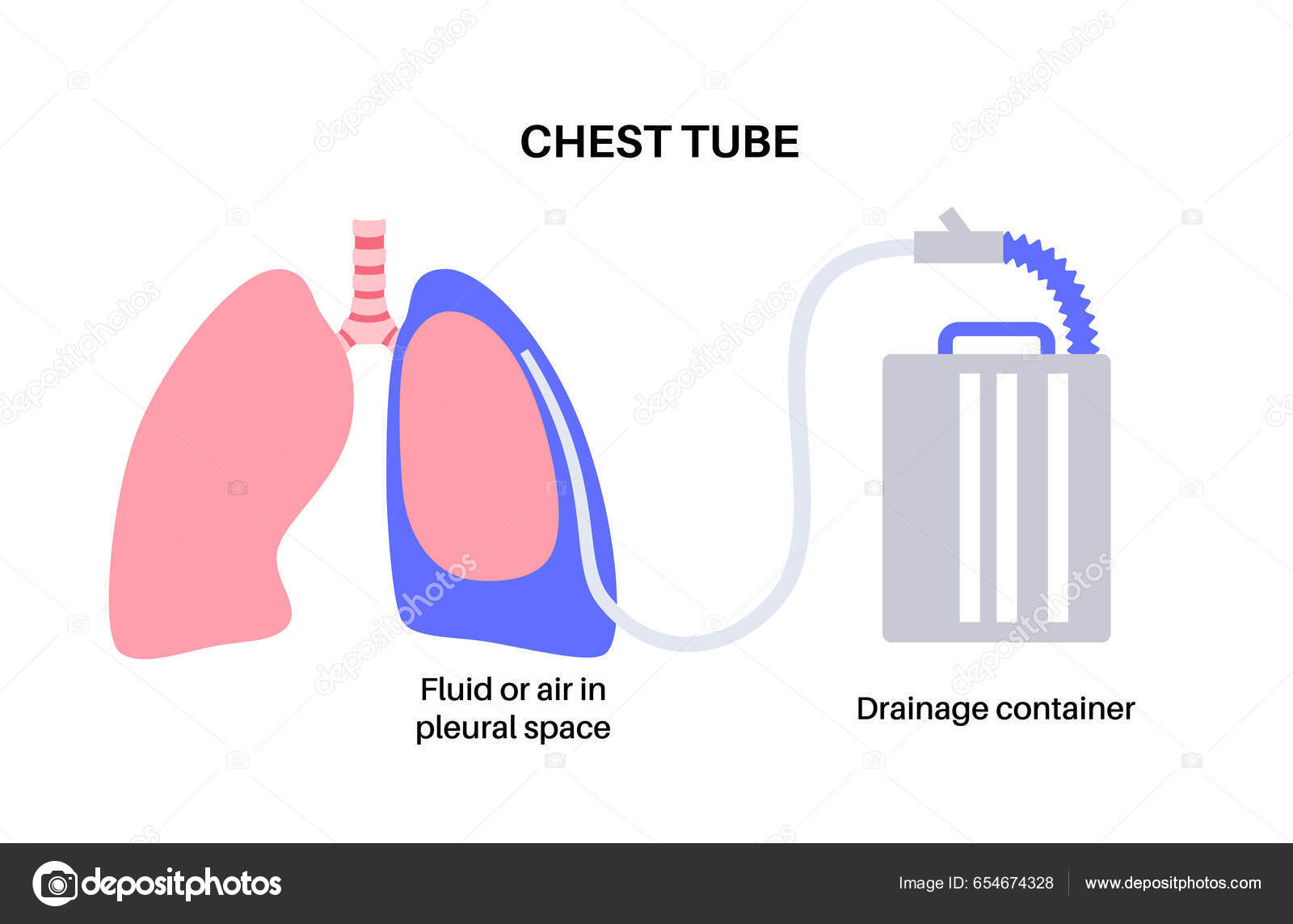 Conceito Tubo Torácico Cateter Torácico Tubo Toracostomia Drenar Fluido ...