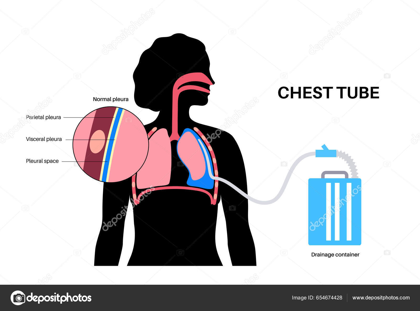 Conceito Tubo Torácico Cateter Torácico Tubo Toracostomia Drenar Fluido ...