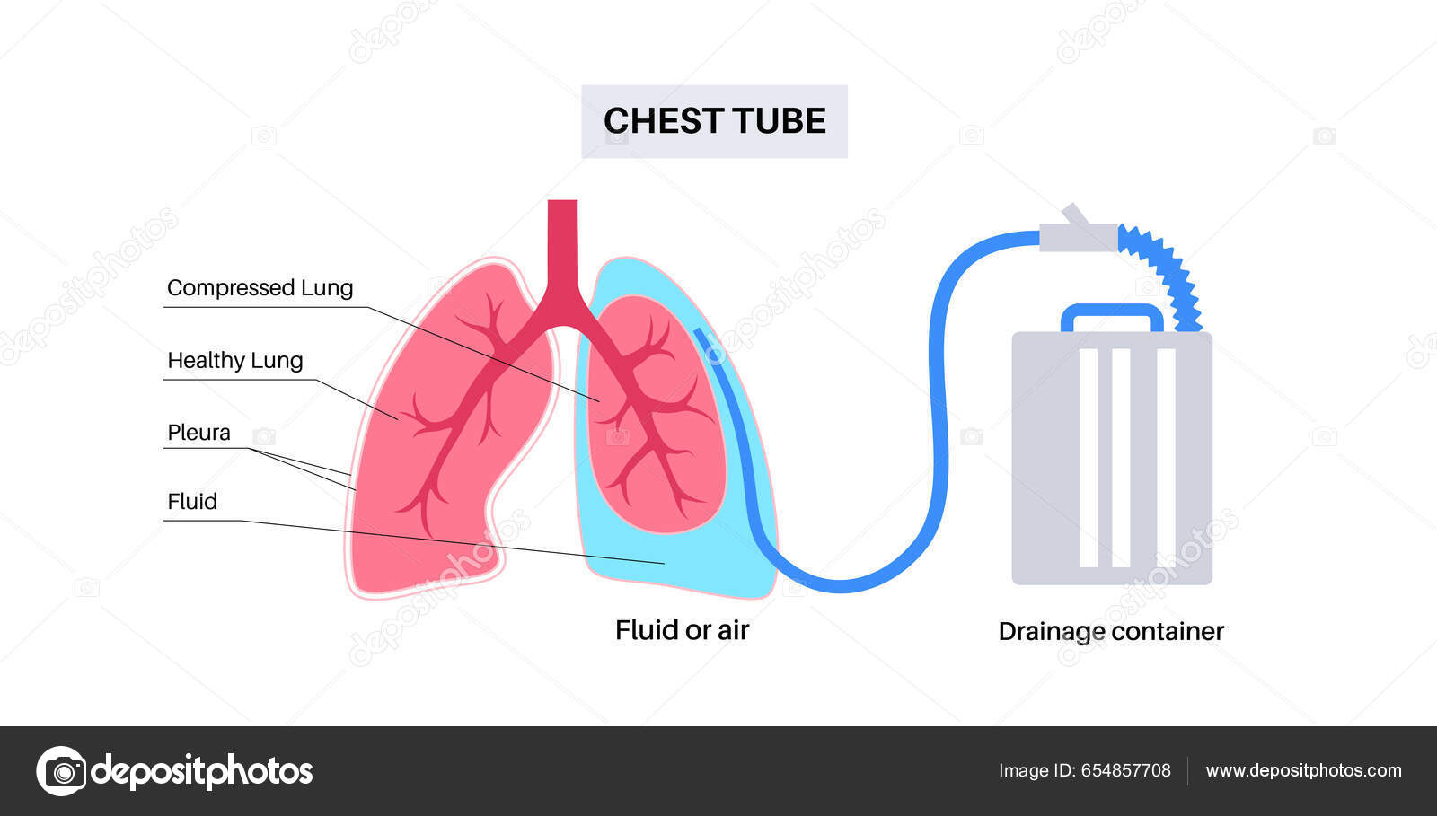 Tubo Torácico Concepto Catéter Torácico Toracostomía Por Sonda Drena ...