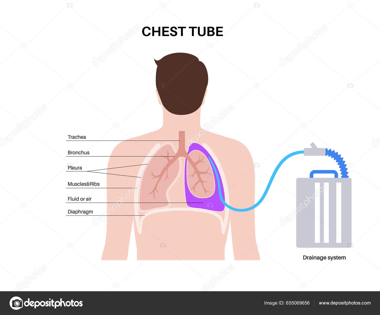 Tubo Torácico Concepto Catéter Torácico Toracostomía Por Sonda Drena ...
