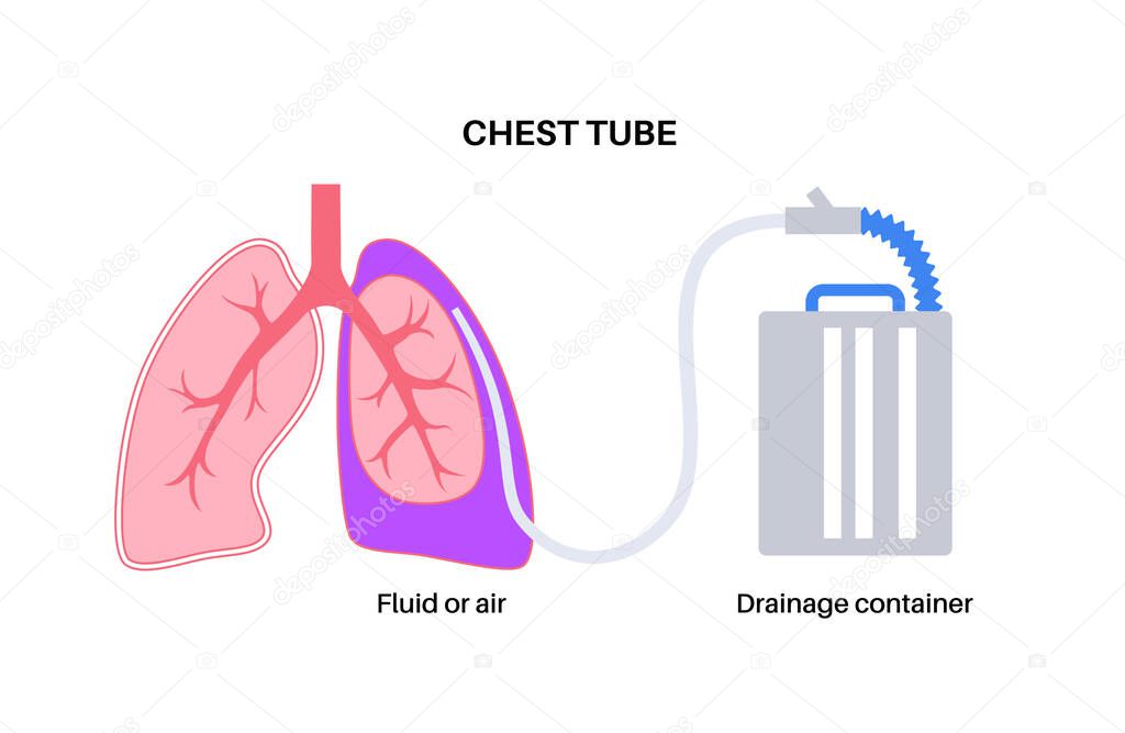 Tubo torácico o concepto de catéter torácico. La toracostomía por sonda ...