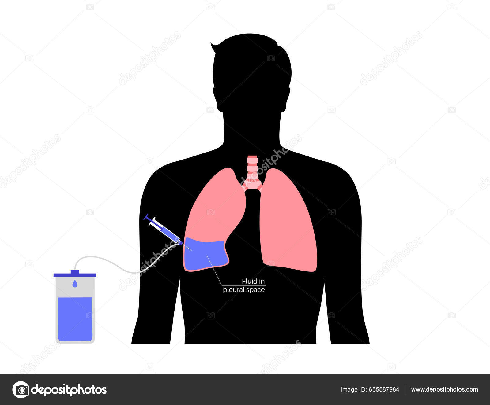 Etapas Do Procedimento De Toracocentese