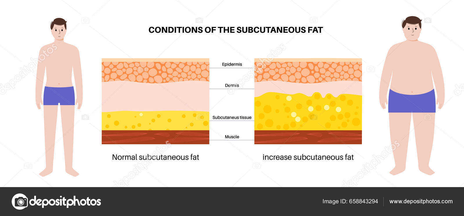 Condiciones Grasa Subcutánea Cuerpo Humano Concepto Celulitis Exceso ...