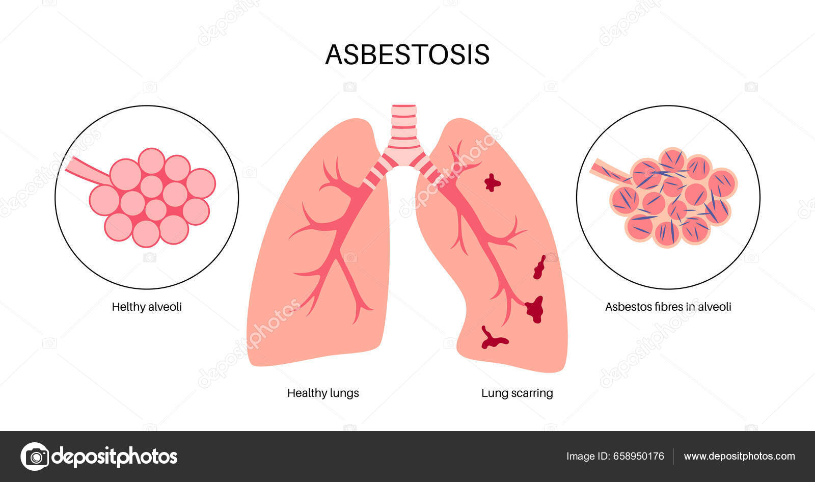 Image vectorielle Affiche Anatomique Sur L'asbestose Concept Maladie ...