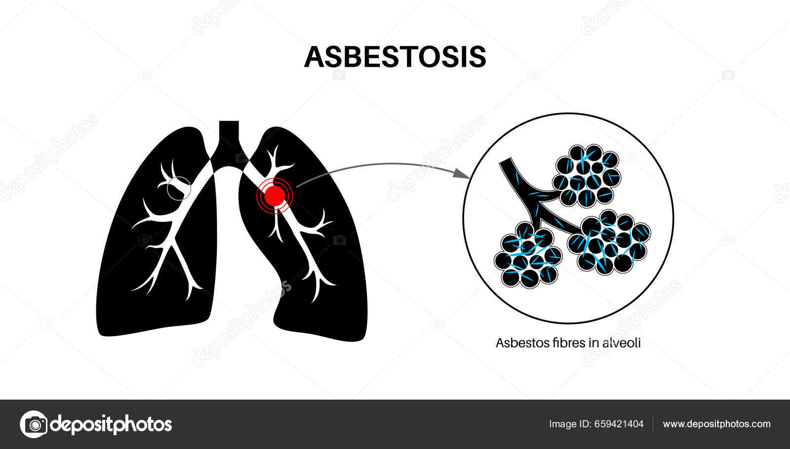 Poster Anatomi Asbestosis Konsep Penyakit Paru Paru Serat Asbes ...