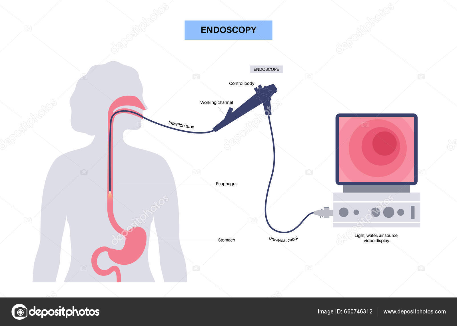 Procedimiento Gastroscopia Gastroenterólogo Usa Gastroscopio Endoscopia ...