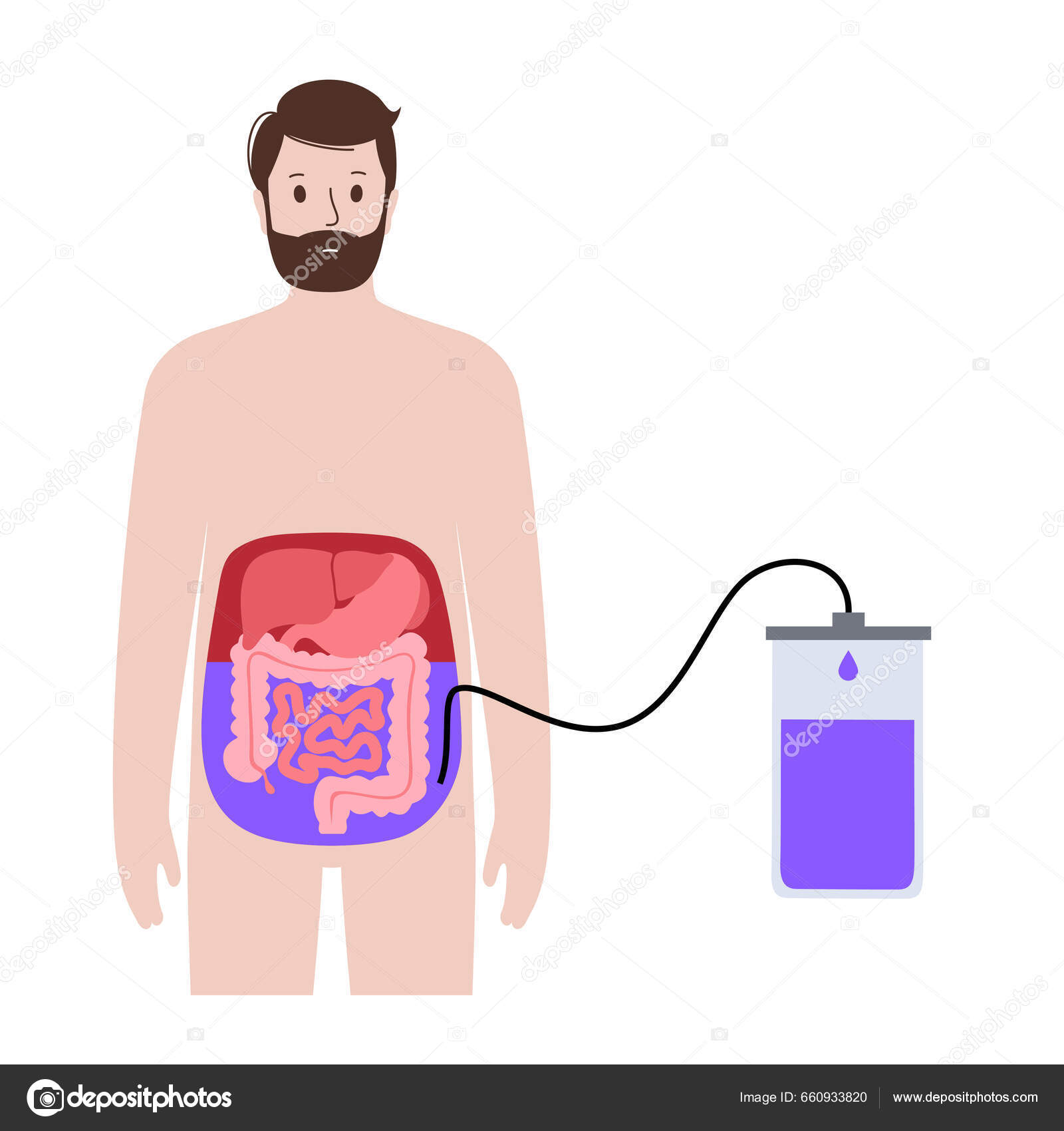 Procedimento Paracentese Abdominal Fluido Abdómen Escorra Líquido ...