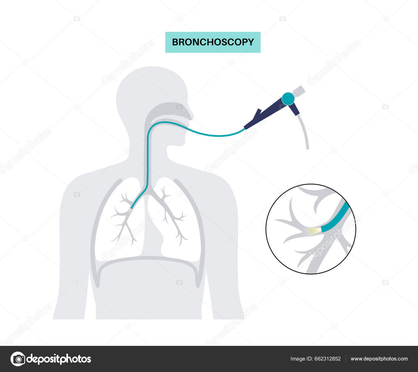 Image vectorielle Procédure Bronchoscopie Pneumologue Utilise ...