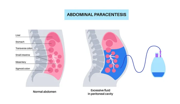 Diagrama Da Cavidade Peritoneal Anatomia Abdominal (cavidade