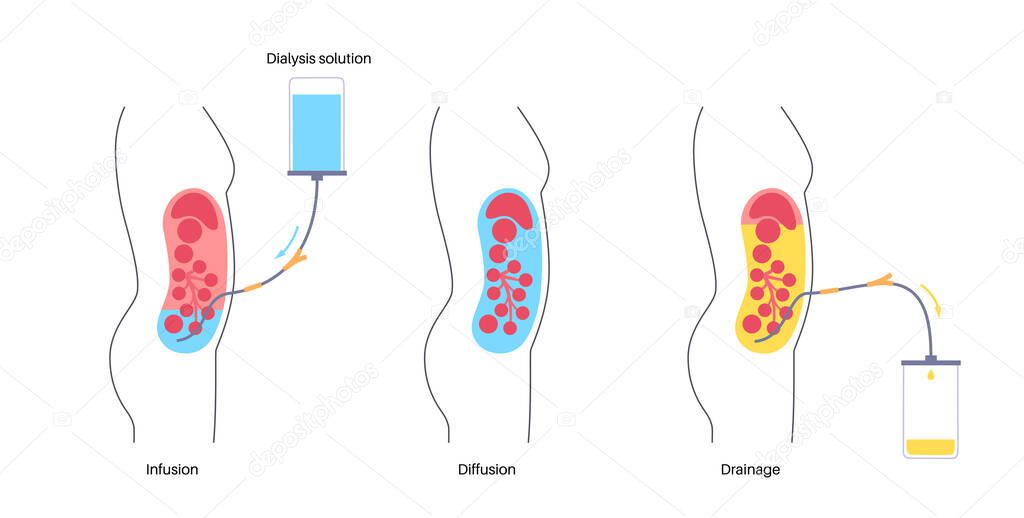Procedimiento de diálisis peritoneal. Fluido en la cavidad peritoneal ...