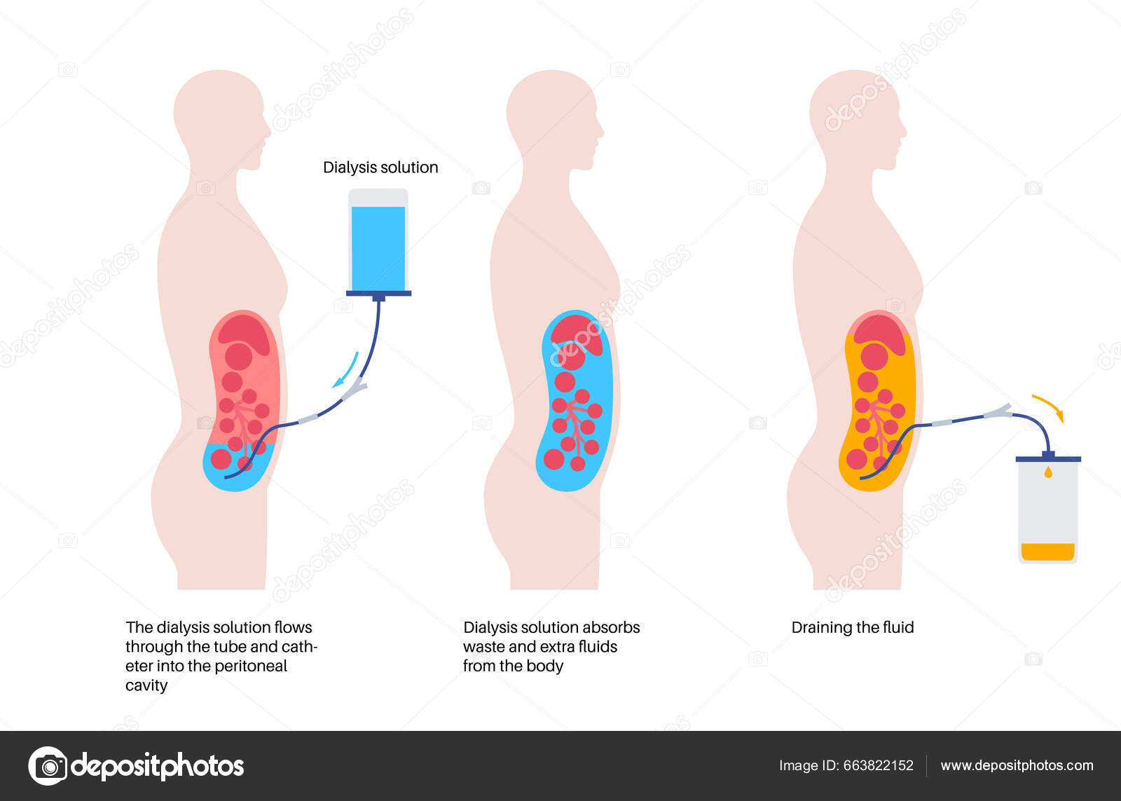 Procedimiento Diálisis Peritoneal Fluido Cavidad Peritoneal Peritoneo ...