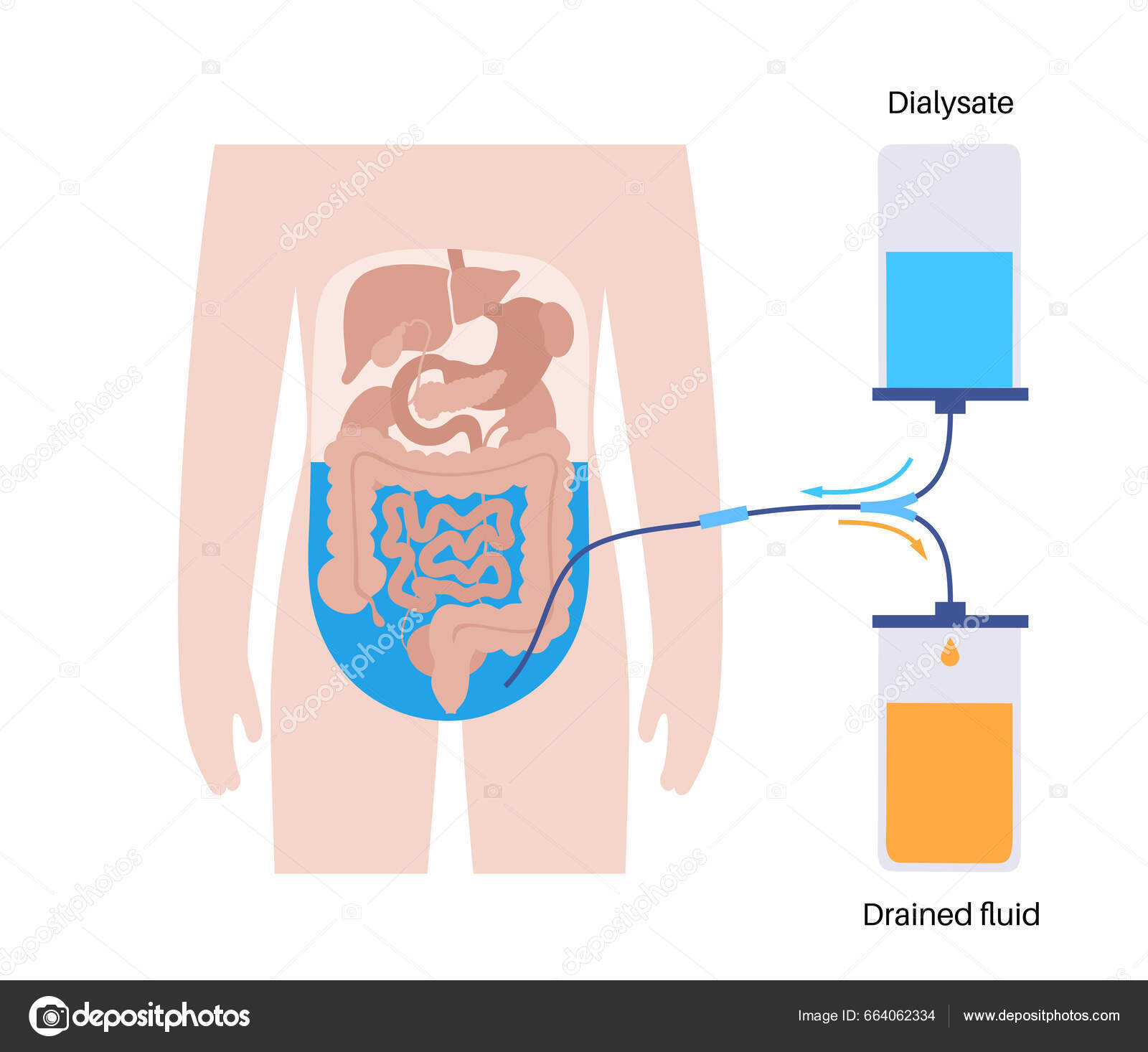 Procedimiento Diálisis Peritoneal Fluido Cavidad Peritoneal Peritoneo ...