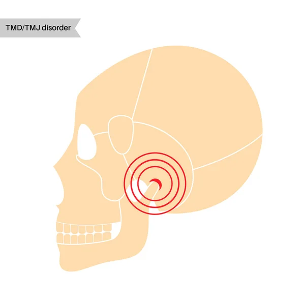 Trastorno temporomandibular de las articulaciones. TMD o disfunción de ...