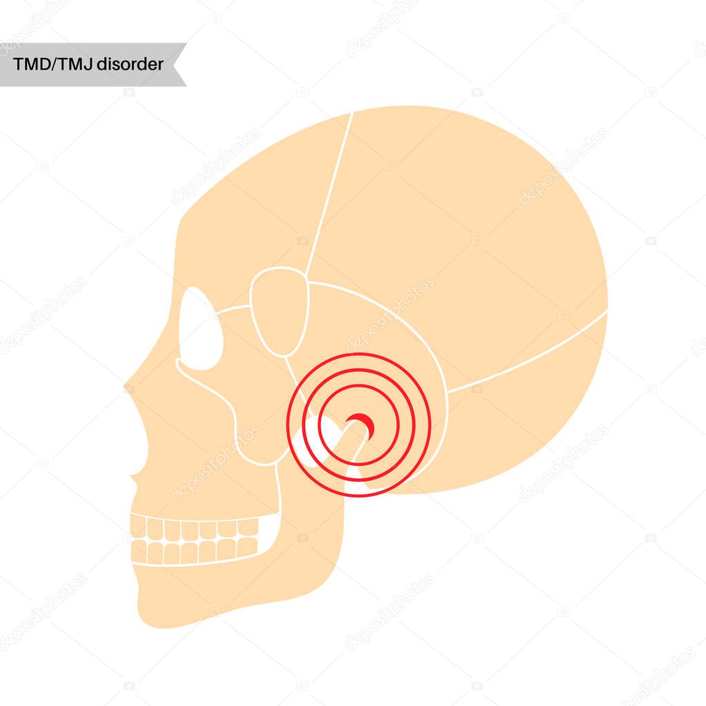 Trastorno temporomandibular de las articulaciones. TMD o disfunción de ...